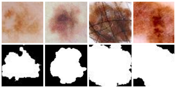 RECOGNITION OF SKIN MELANOMA THROUGH DERMOSCOPIC IMAGE ANALYSIS ...